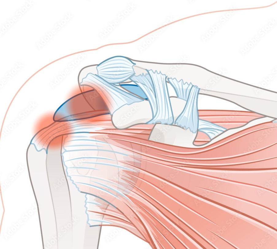 Rotator Cuff Tendinitis: Understanding, Treating, and Preventing Shoul ...